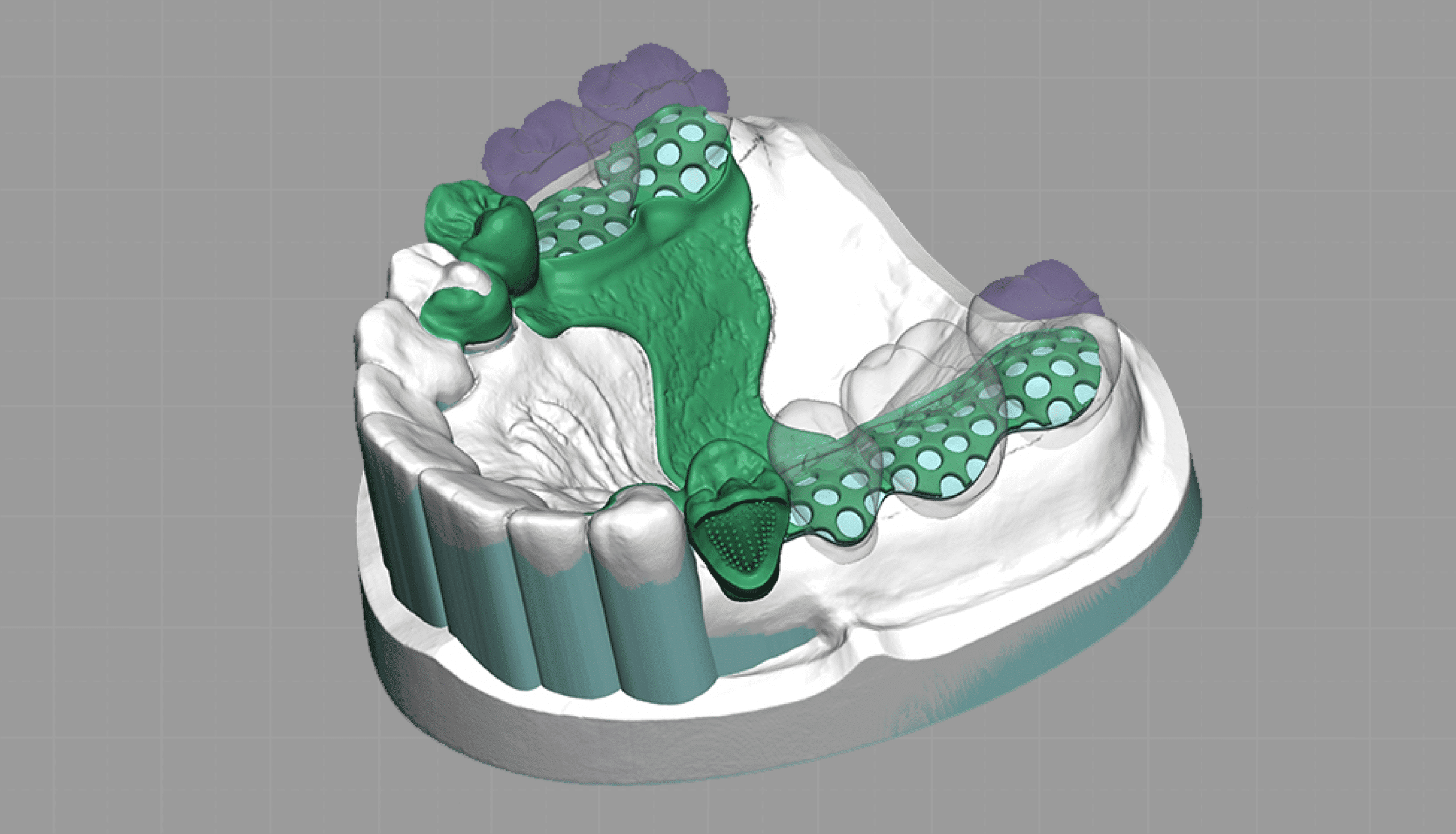 Partial Denture | Evolve Dentistry