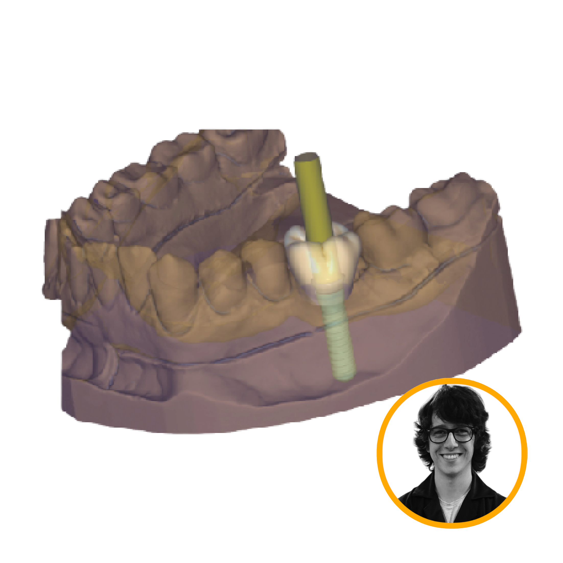 Screw Retained Crown | Evolve Dentistry