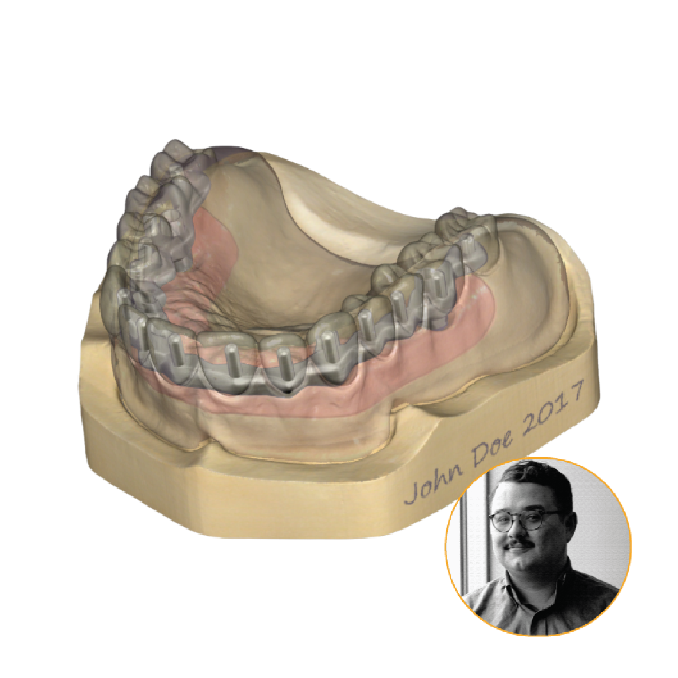 Implant Bar Design | Evolve Dentistry