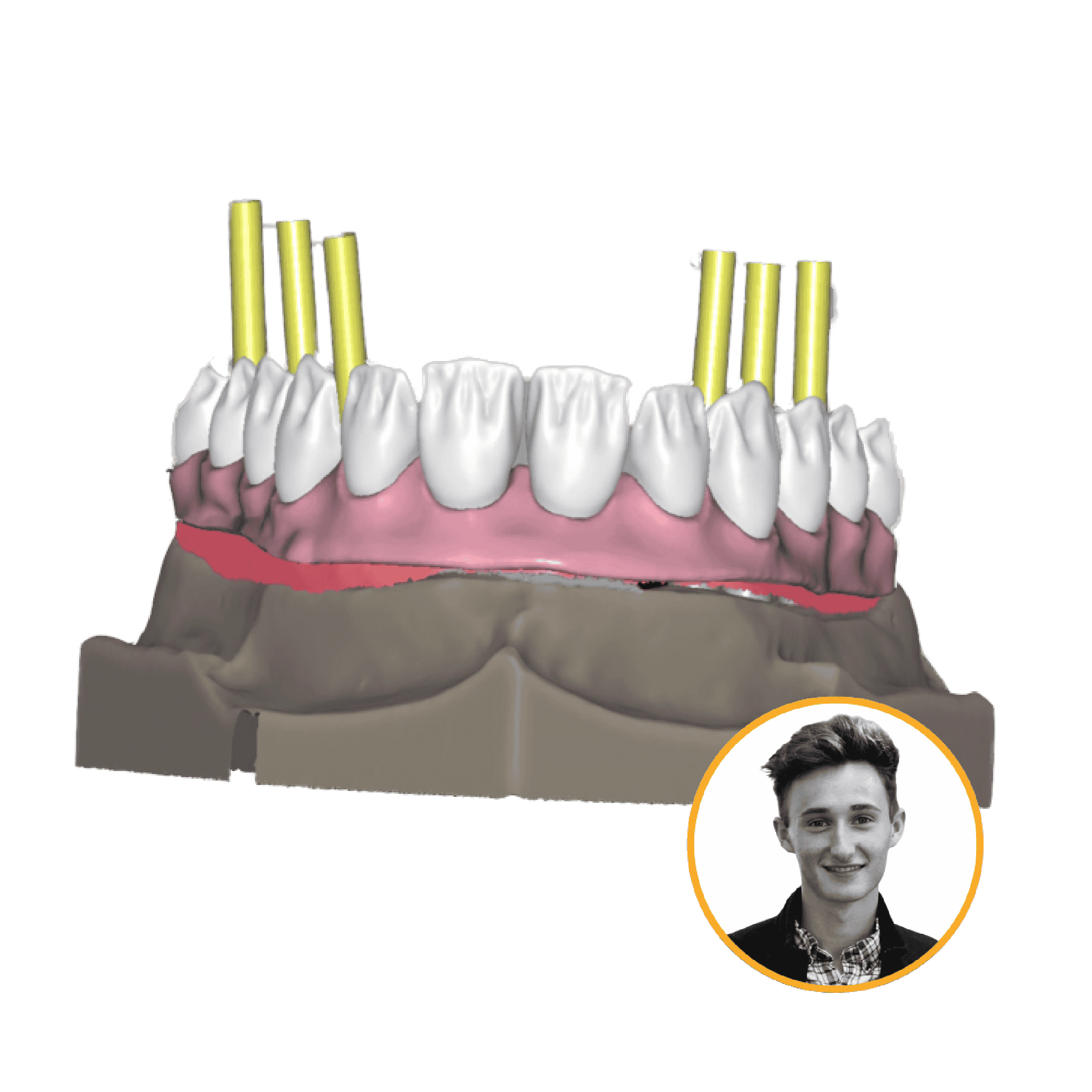 Full Arch - All on X | Evolve Dentistry
