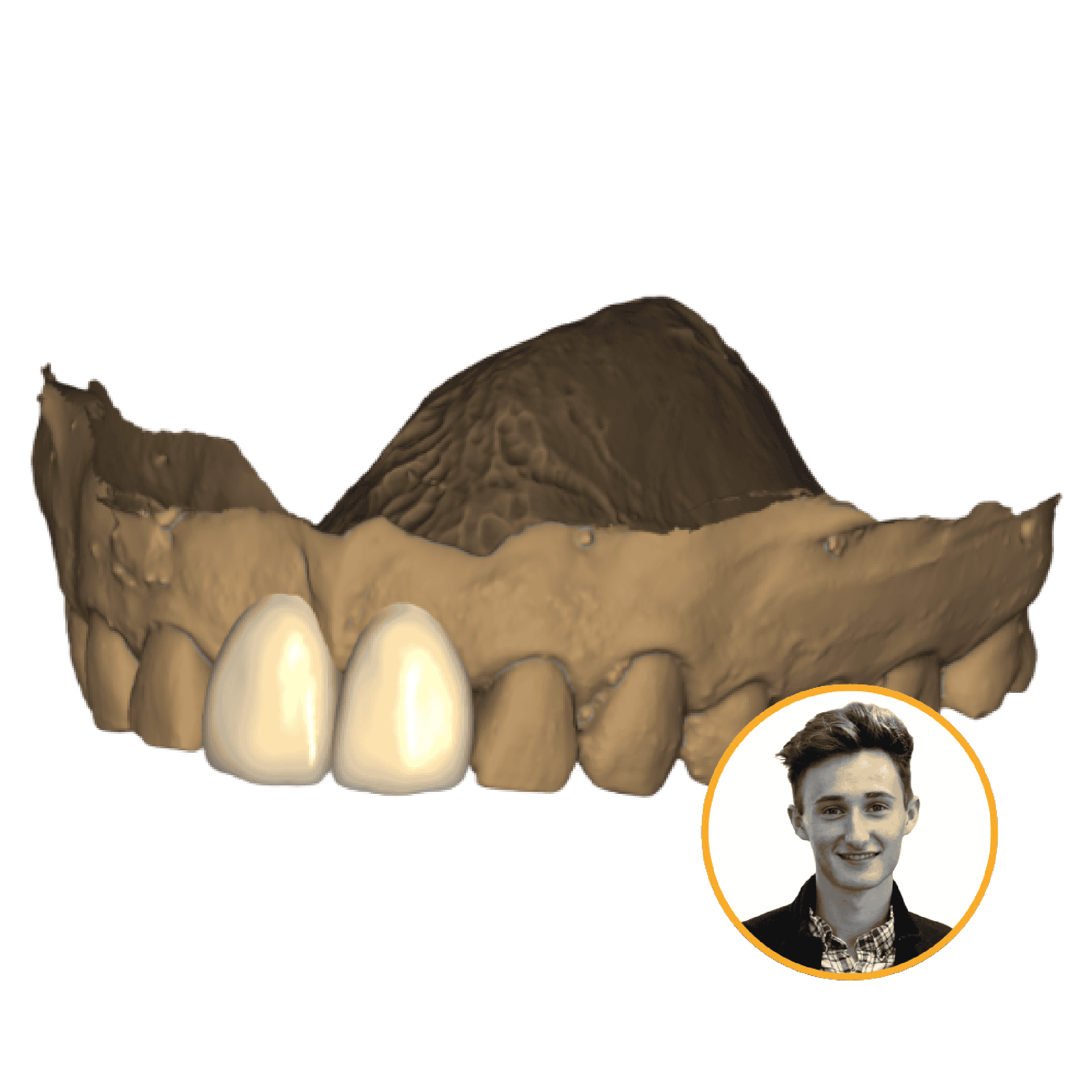 Veneer | Evolve Dentistry