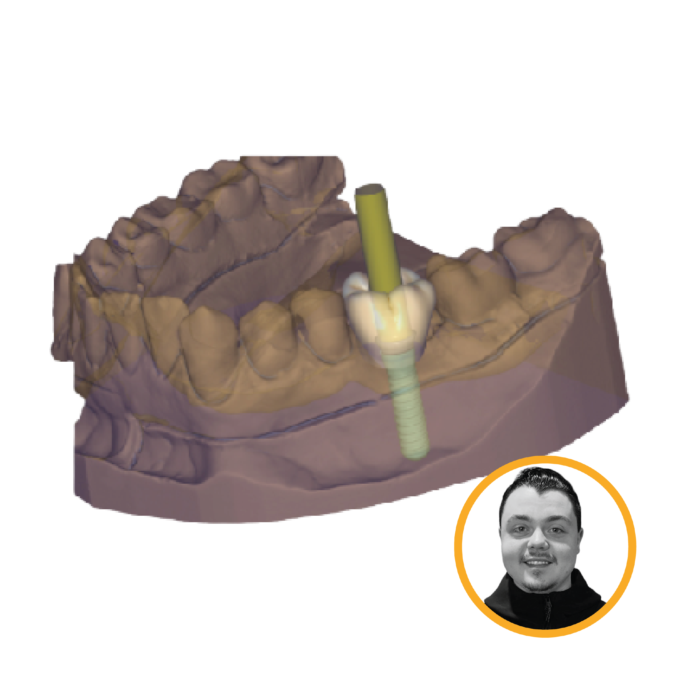 Screw Retained Crown | Evolve Dentistry