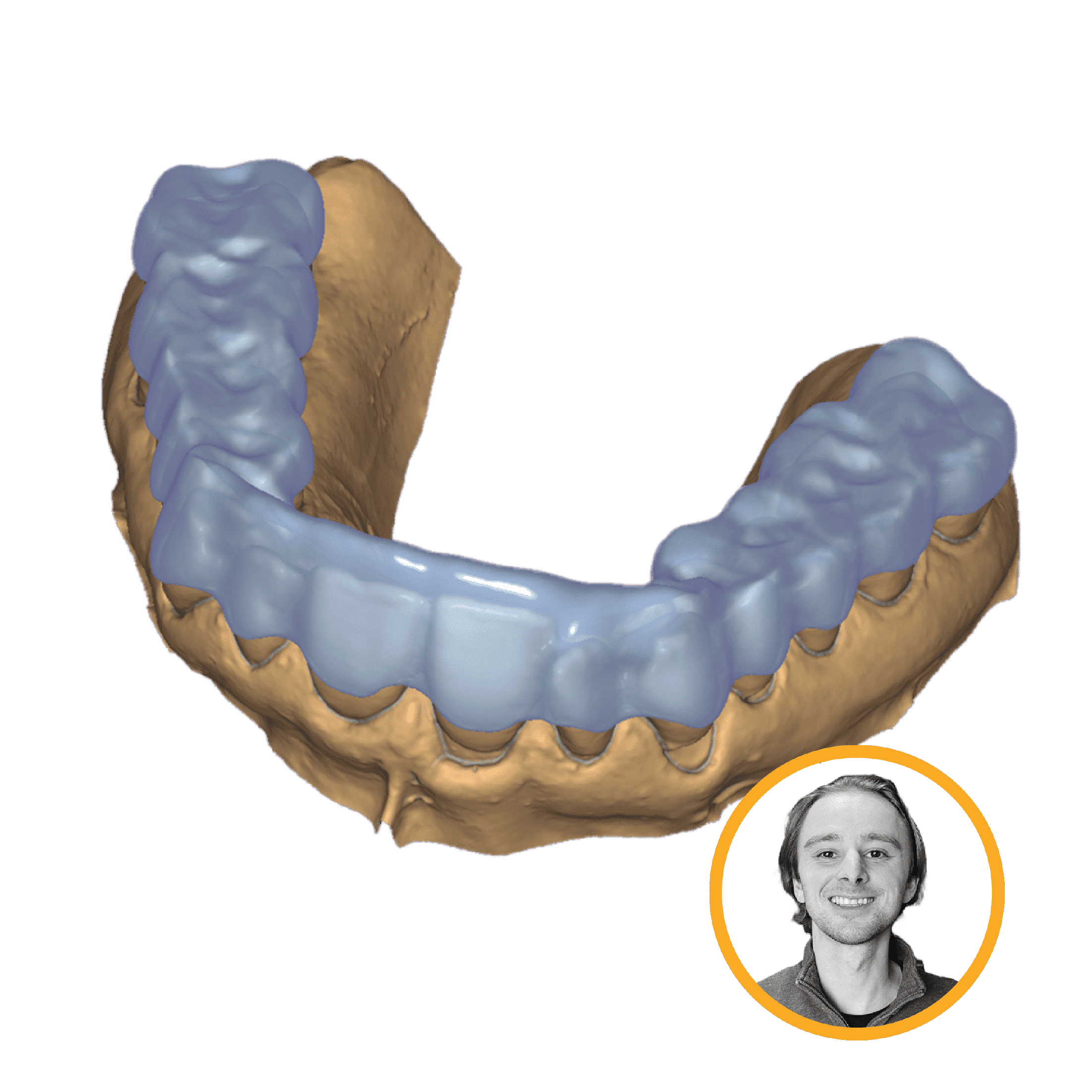 Bite Splint Design | Evolve Dentistry
