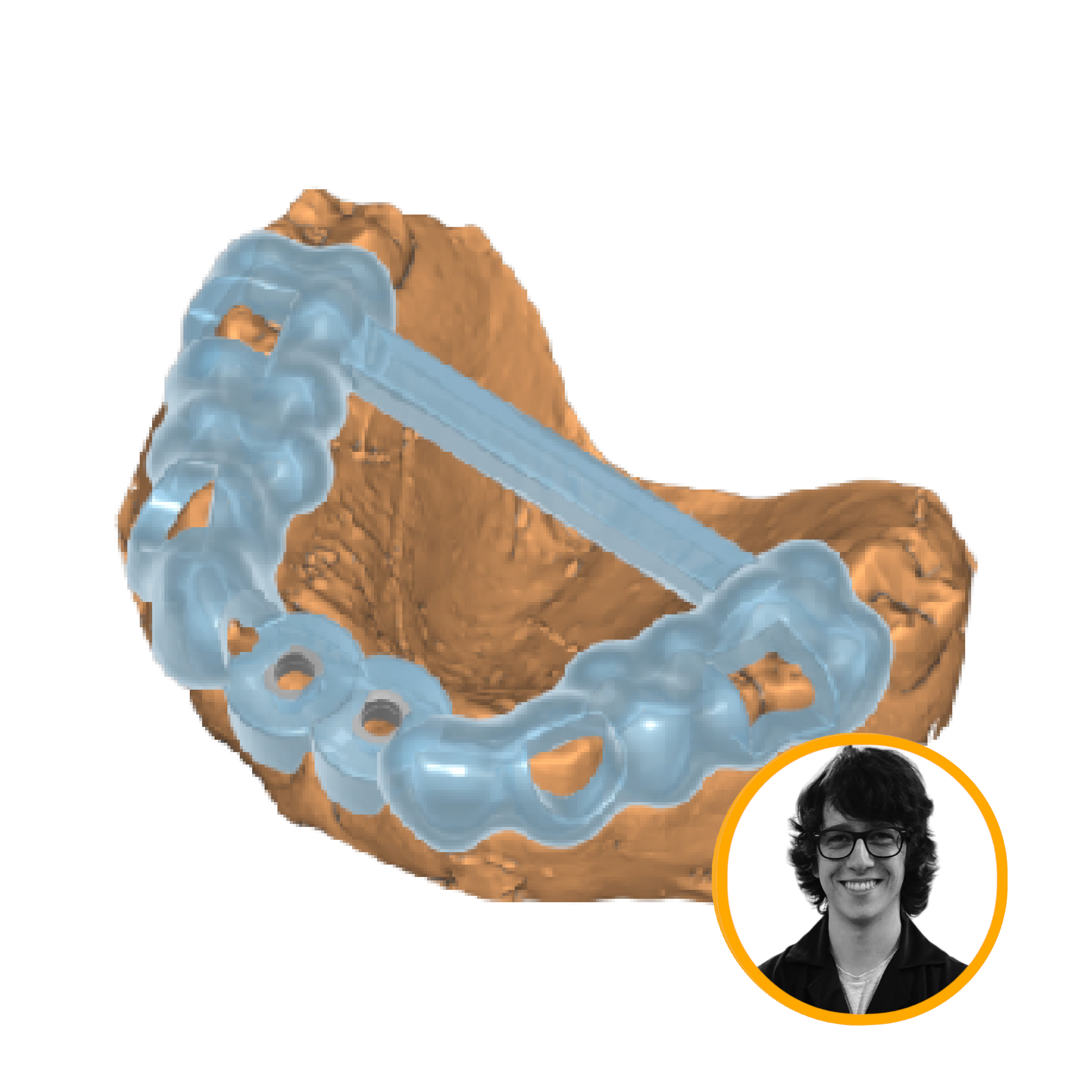 Surgical Guide Design | Evolve Dentistry