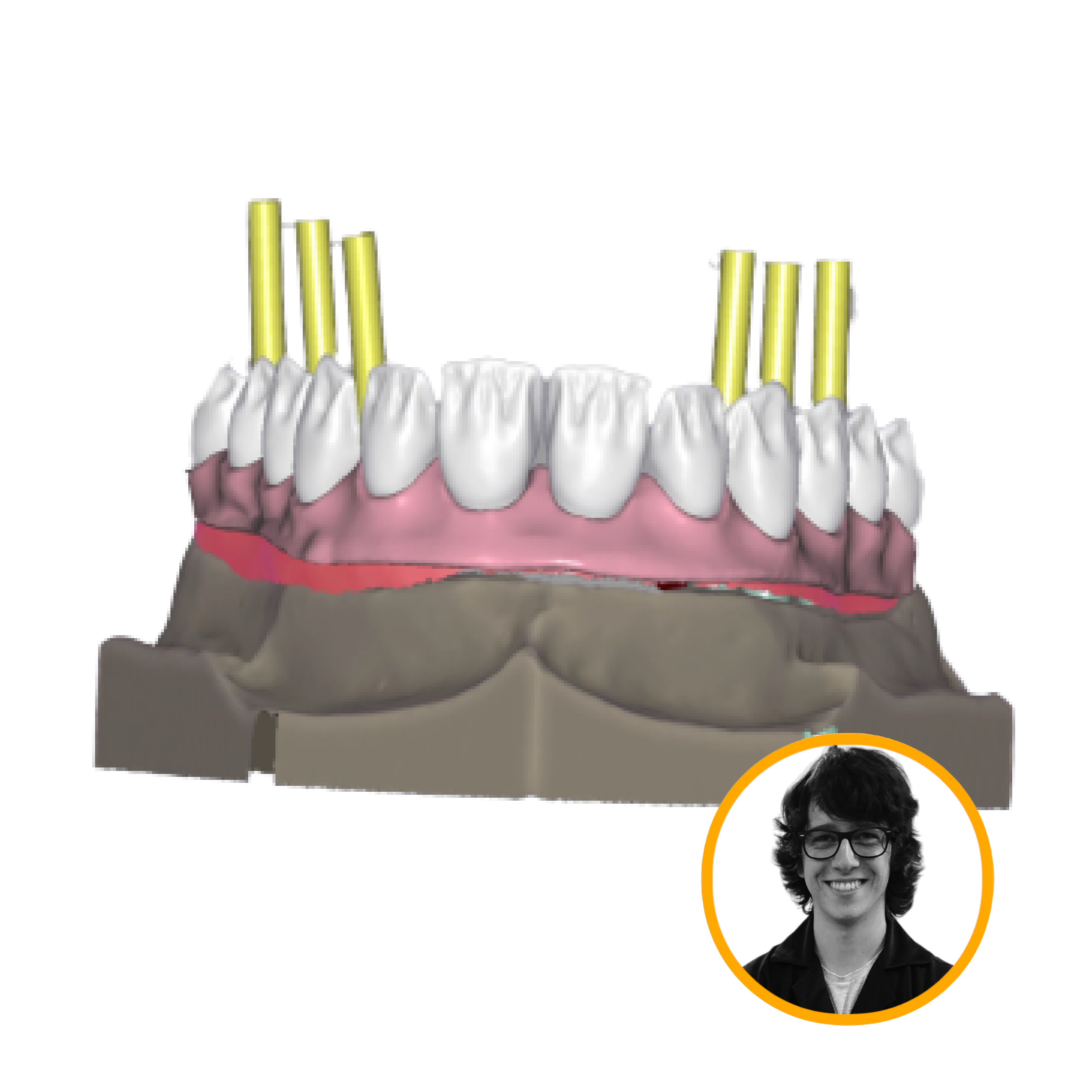 Full Arch - All on X | Evolve Dentistry