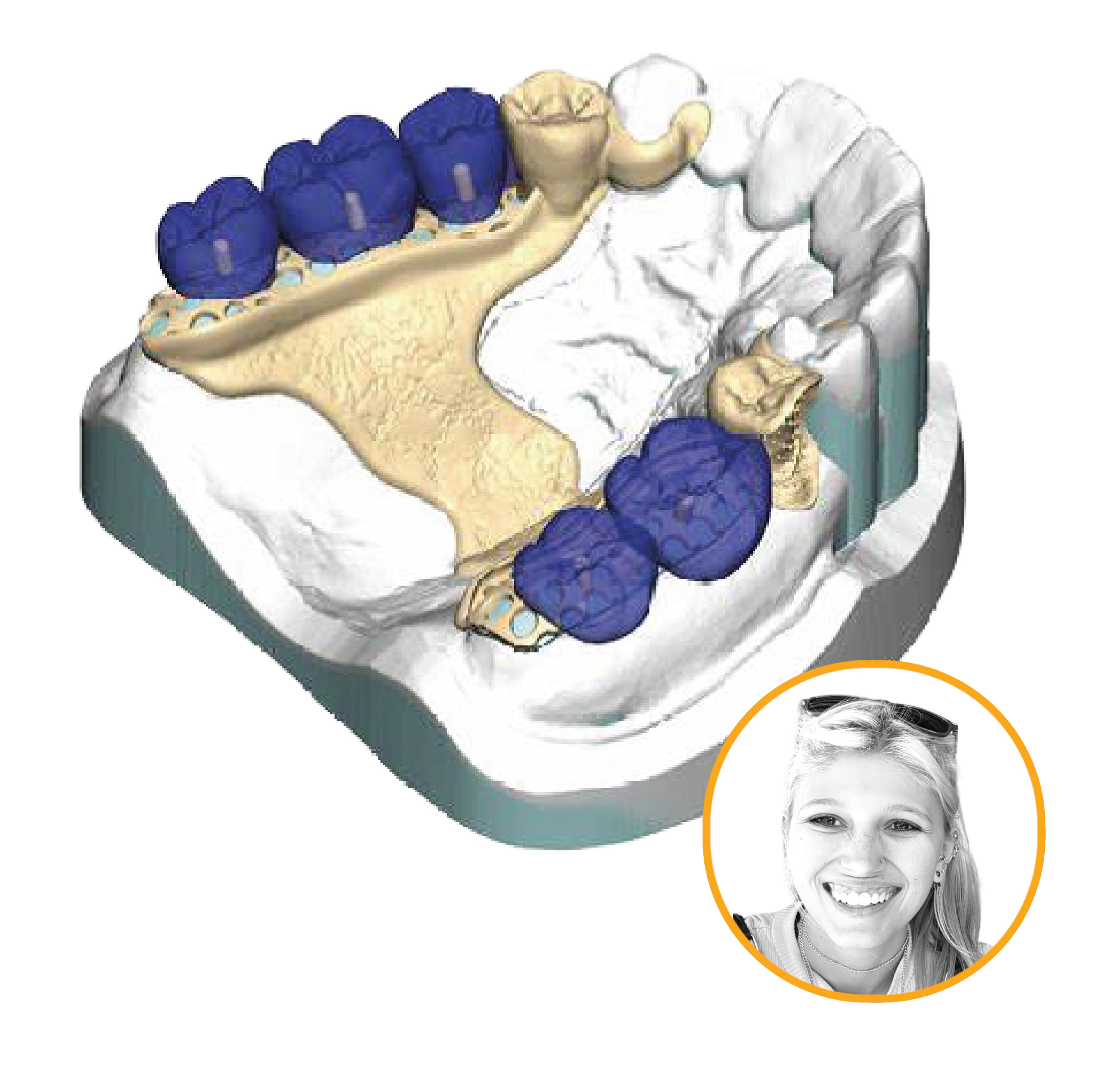 Partial Denture | Evolve Dentistry