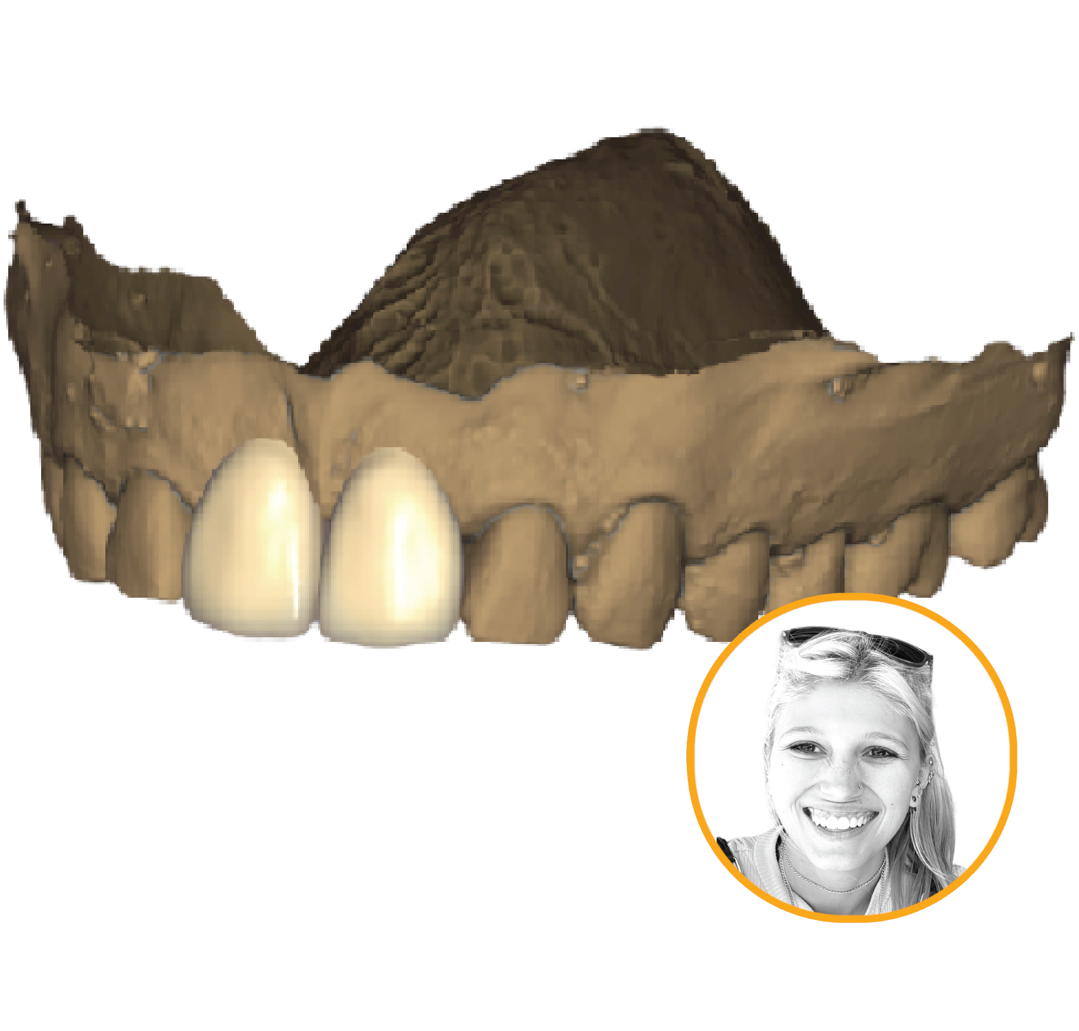 Veneer | Evolve Dentistry