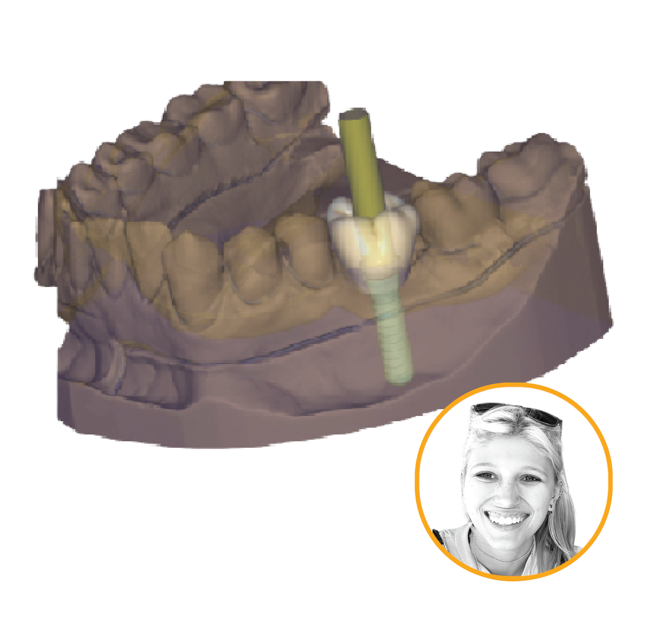Screw Retained Crown | Evolve Dentistry