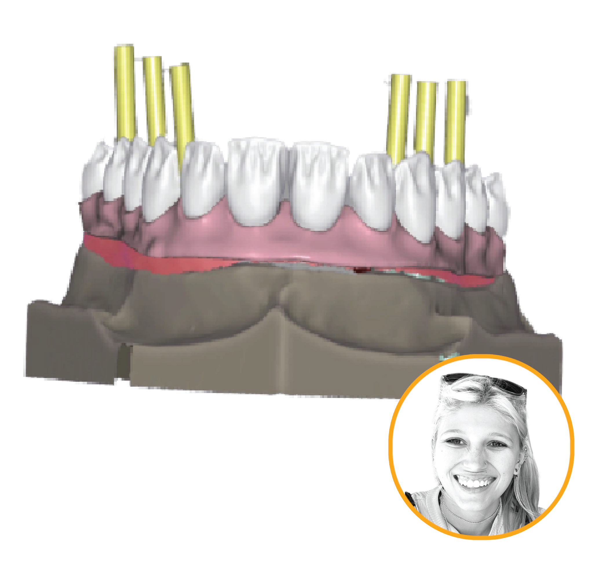 Full Arch - All on X | Evolve Dentistry