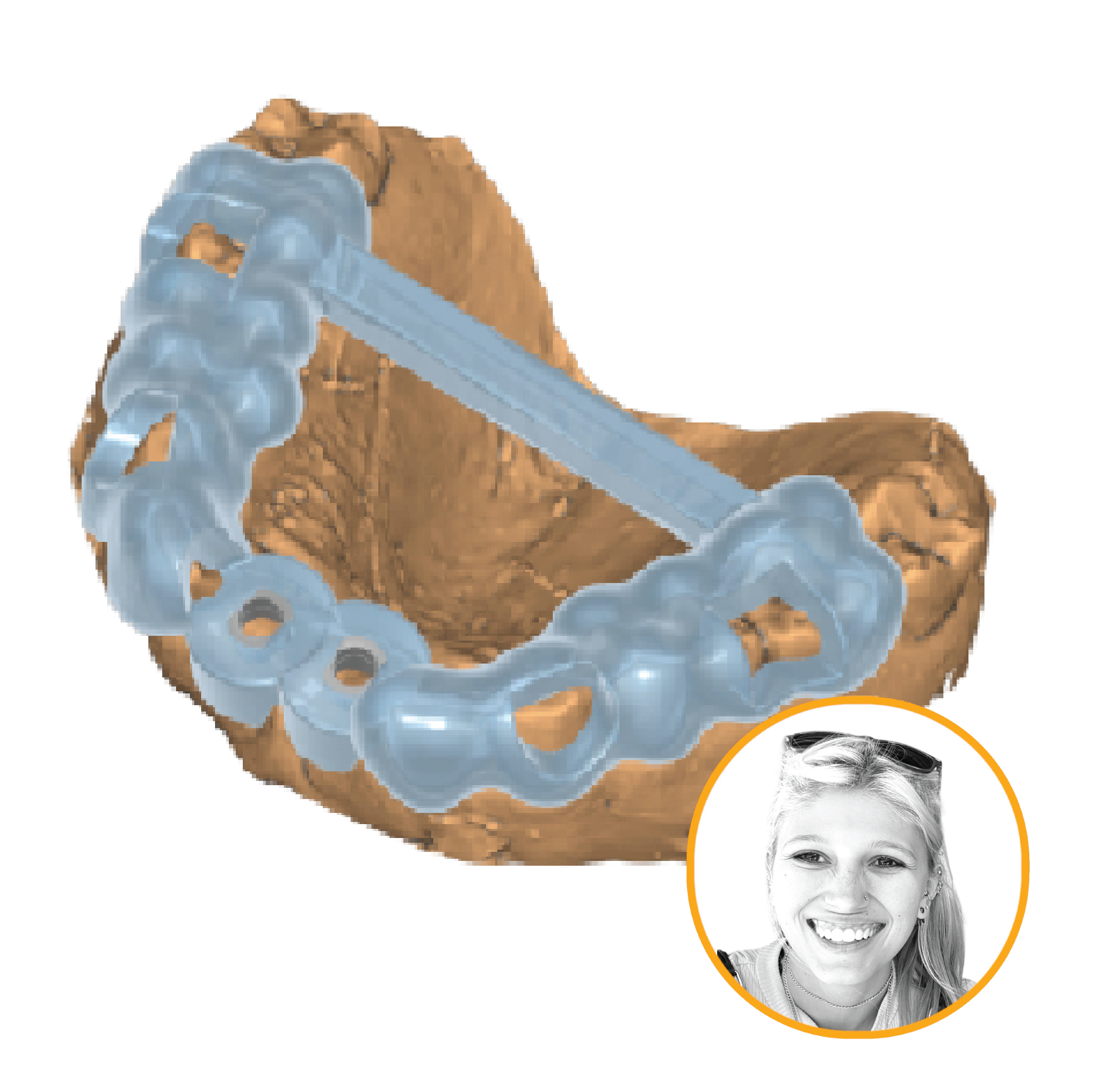 Surgical Guide Design | Evolve Dentistry