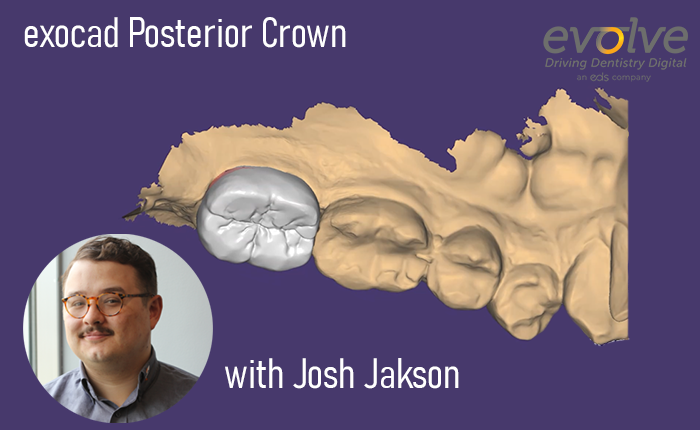 Posterior Crown | Evolve Dentistry